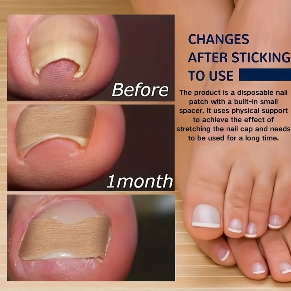 100pcs Ingrown Toenail Corrector Pads Gluefree Nail Patches For ...